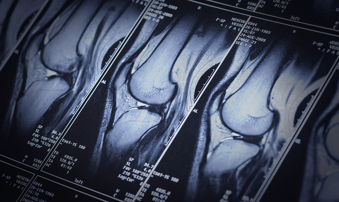 Plica și sindromul de plică – JointCare